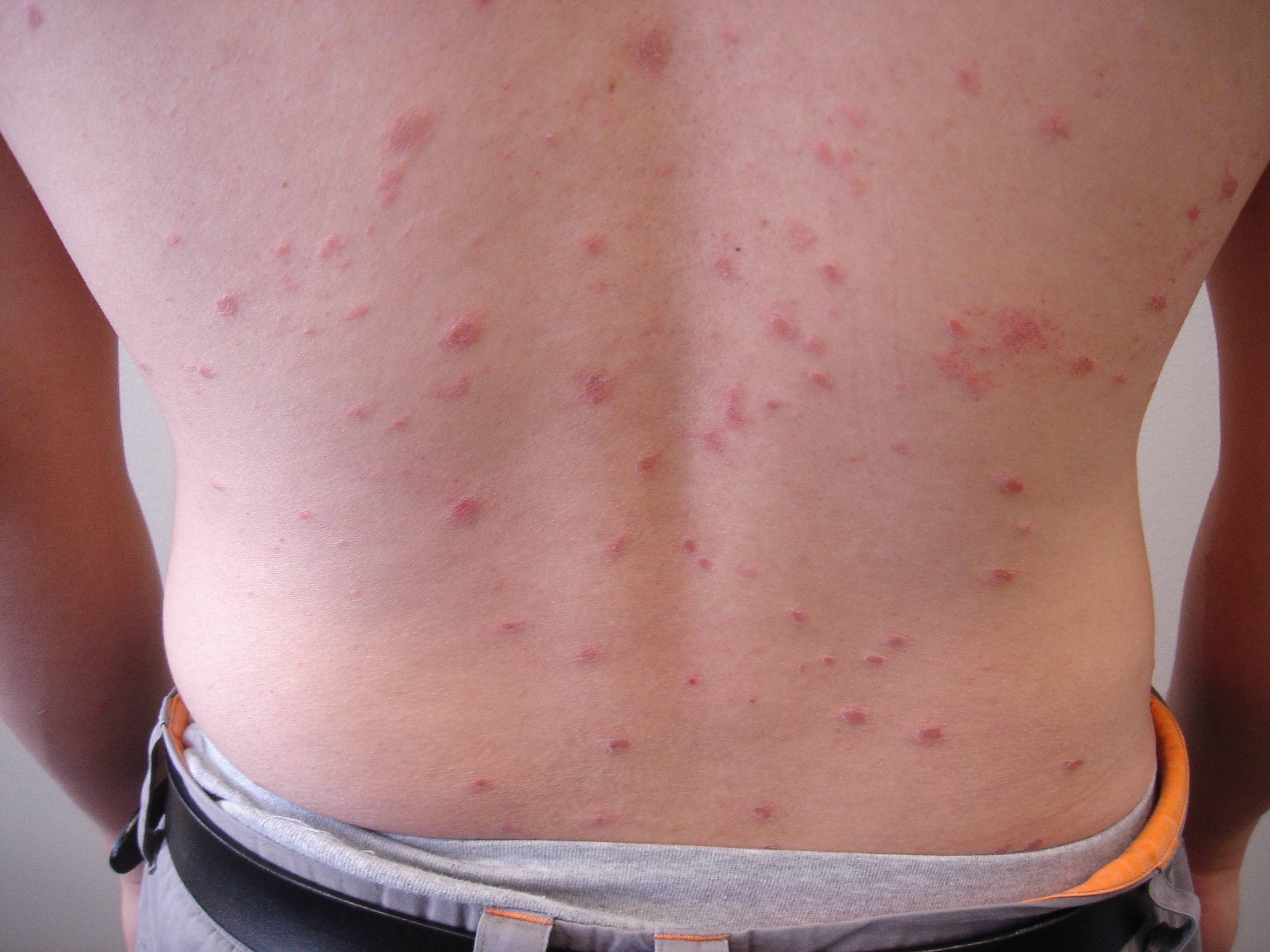 TeamPraxis | Röschenflechte (Pityriasis rosea)