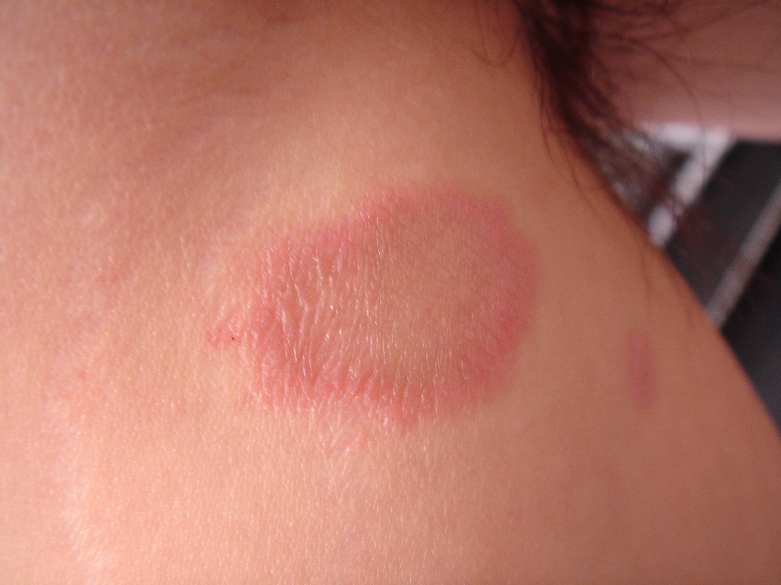 TeamPraxis | Röschenflechte (Pityriasis rosea)
