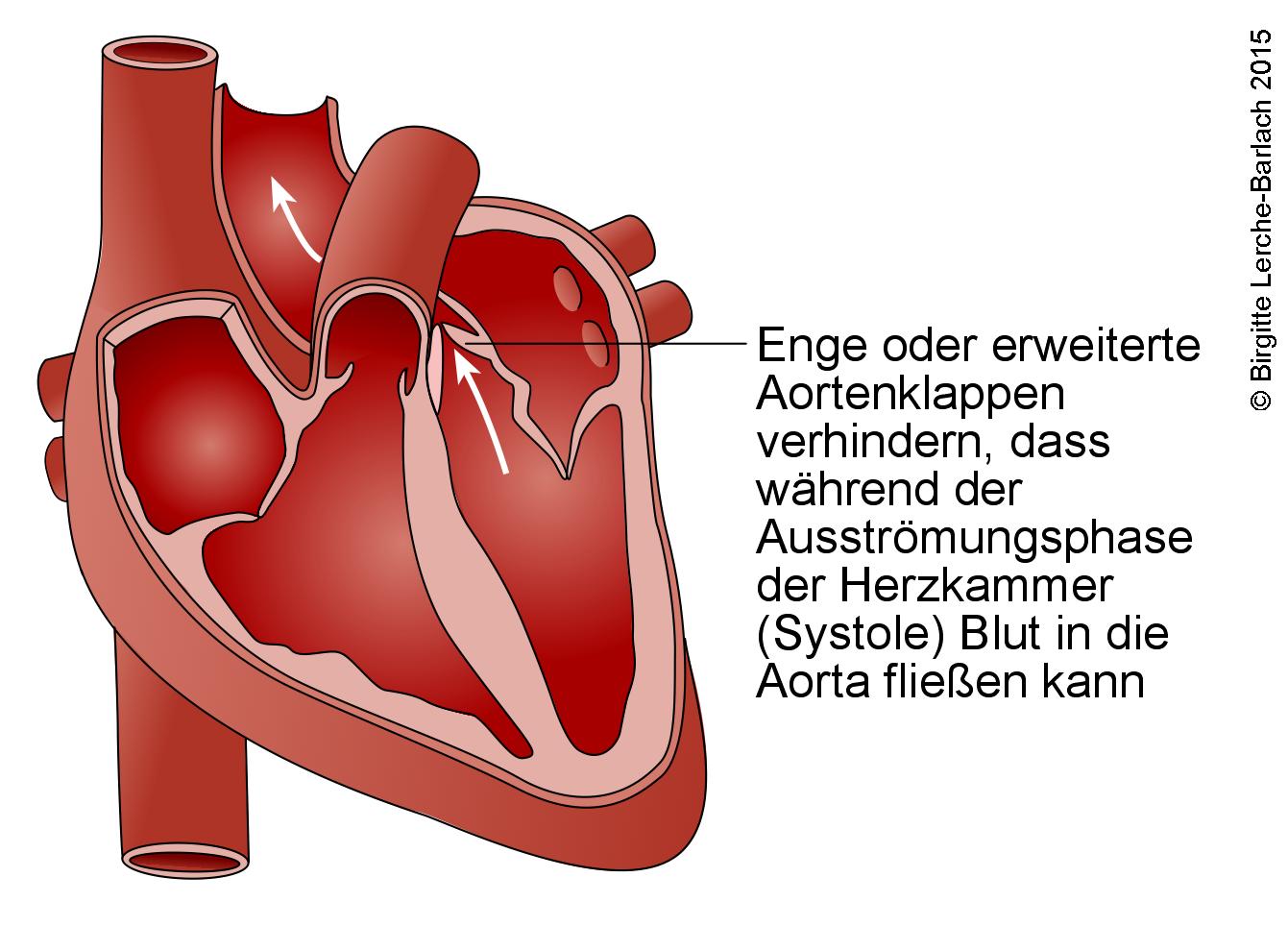 TeamPraxis | Verengung der Aortenklappe (Aortenstenose)