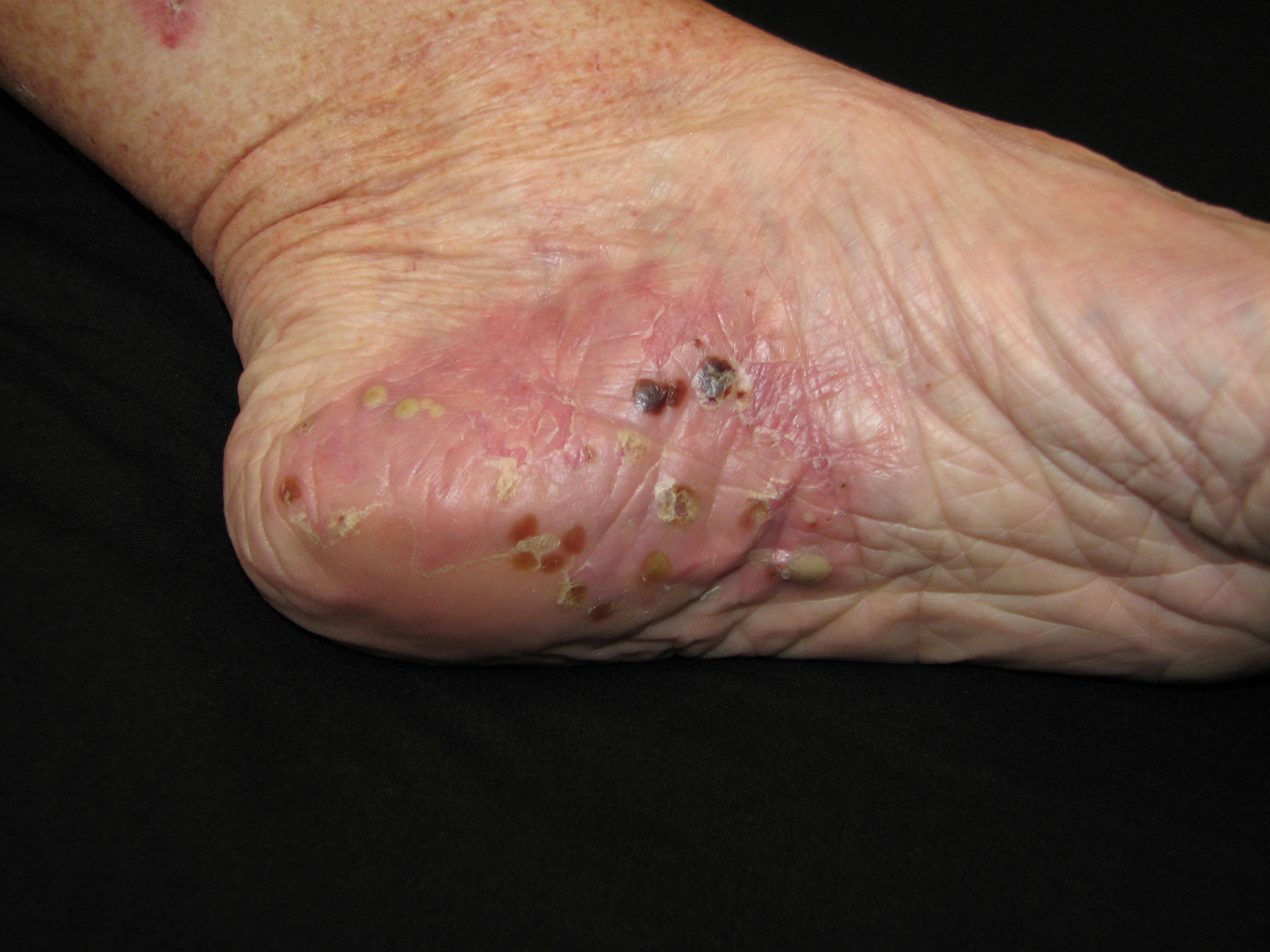 TeamPraxis | Hautausschlag an den Fußsohlen