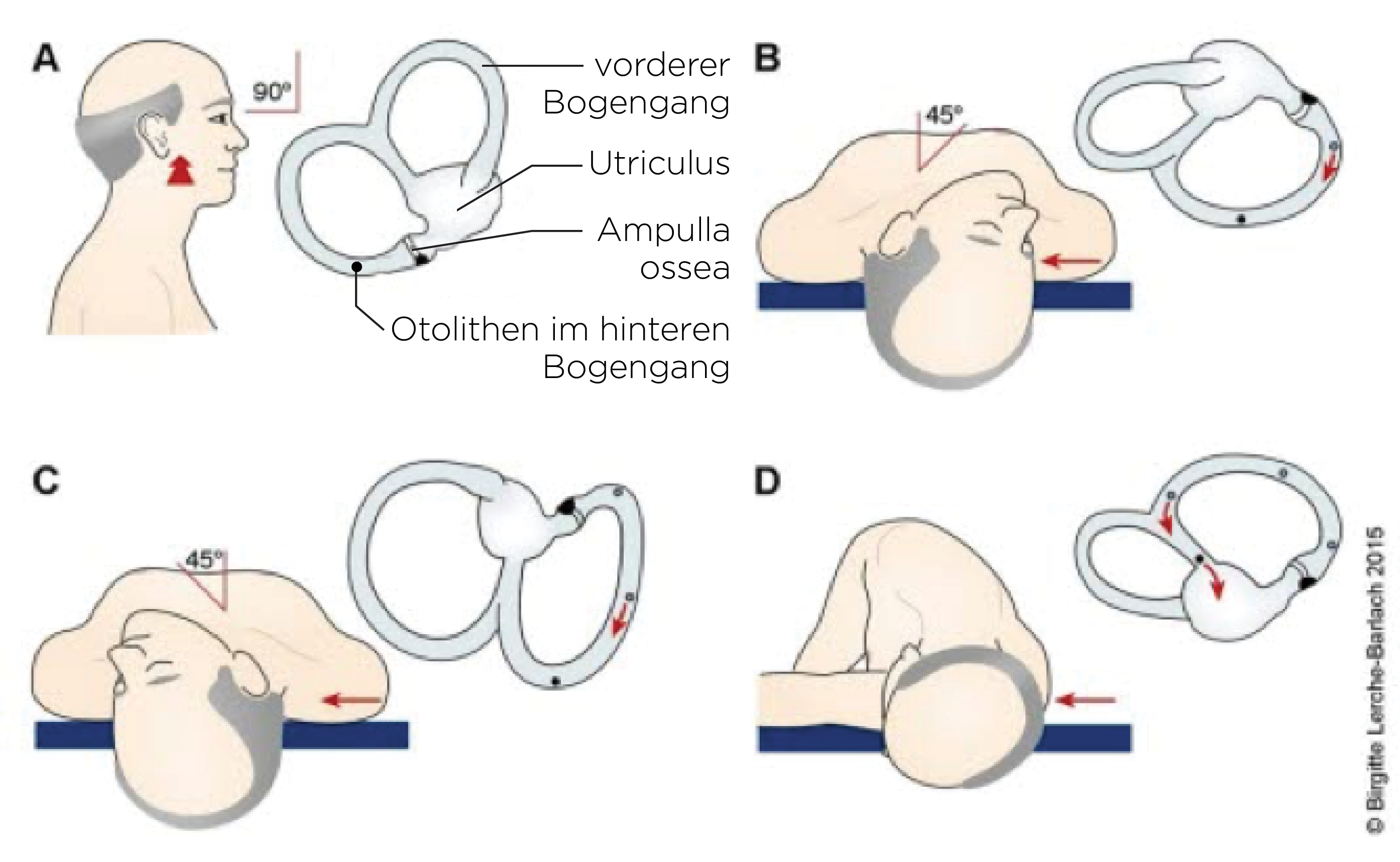 Benigner Paroxysmaler Lagerungsschwindel DEXIMED Deutsche Benigner Paroxysmaler Lagerungsschwindel DEXIMED Deutsche