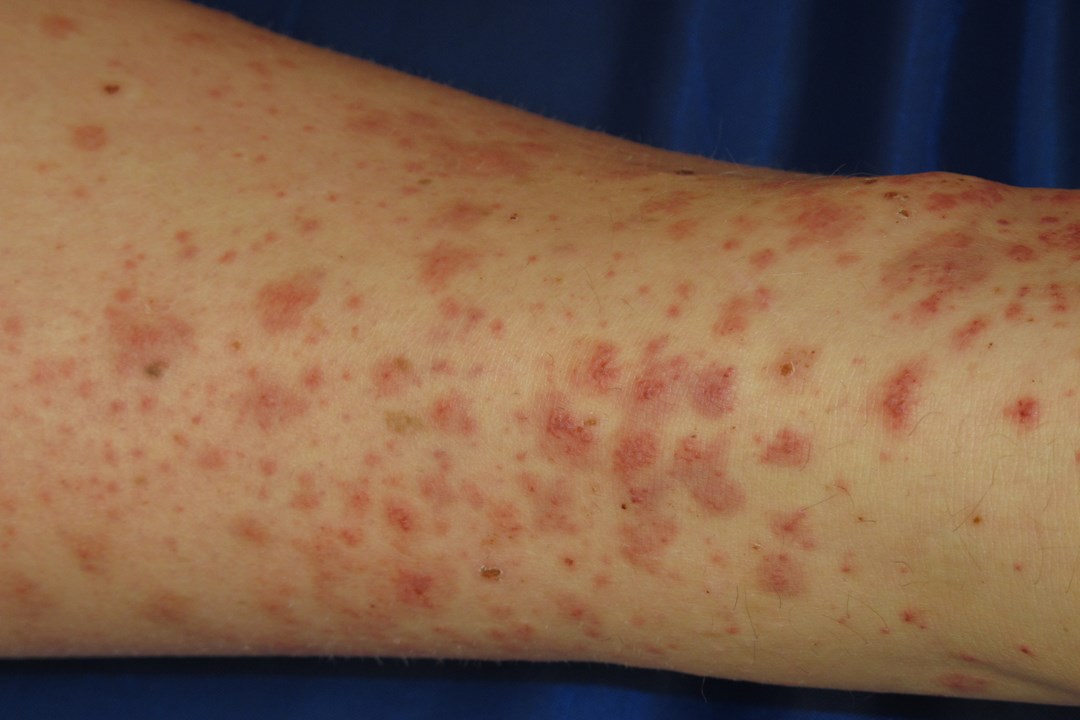 TeamPraxis | IgA-Vaskulitis (Purpura Schönlein-Henoch)