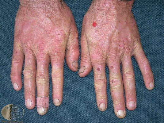 Hautblasen (Vesikel und Bullae) - DEXIMED – Deutsche ...